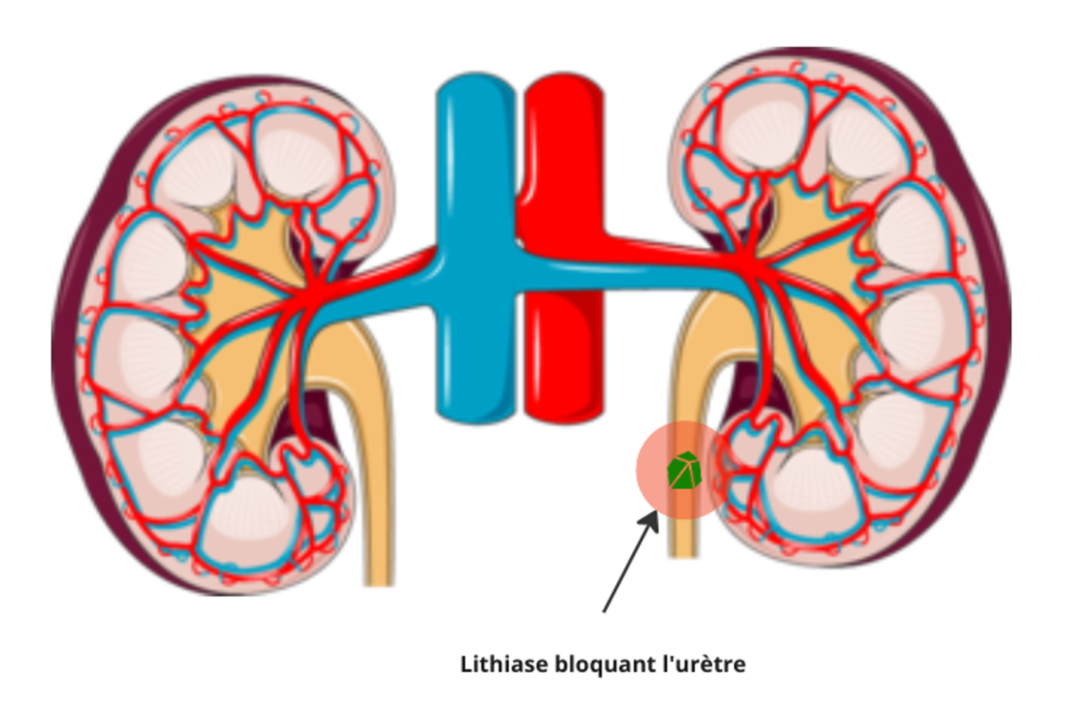 Fiche IDE : Processus obstructifs - Notion Infirmier