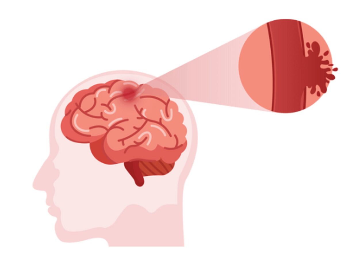 Fiche IDE : l'Accident Vasculaire Cérébral (AVC)