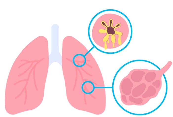 Fiche IDE : Bronchopneumopathie chronique obstructive (BPCO) - Notion ...