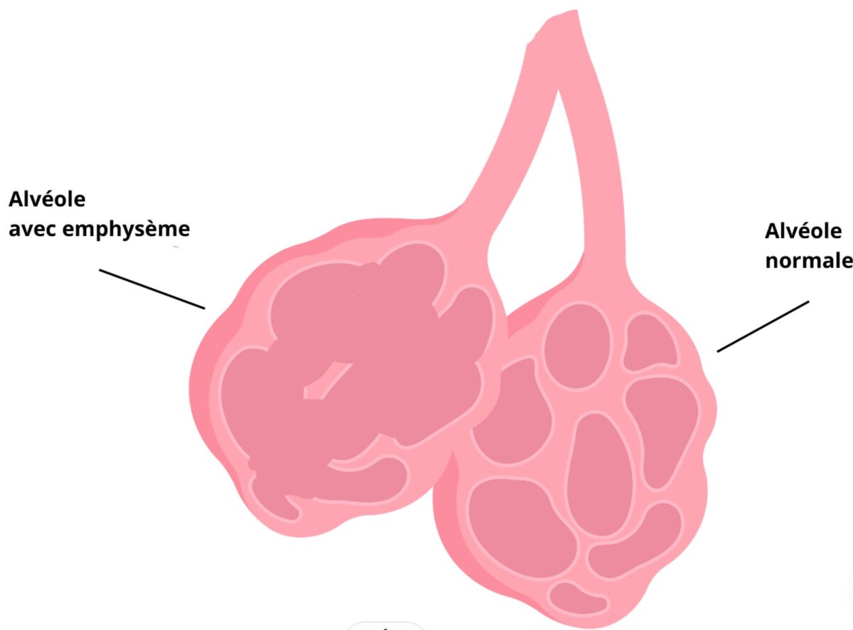 Fiche IDE : Bronchopneumopathie chronique obstructive (BPCO) - Notion ...
