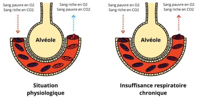 Fiche IDE : Insuffisance Respiratoire Chronique - Notion infirmier