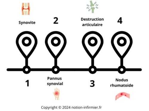 Fiche IDE : Polyarthrite rhumatoïde - Notion Infirmier
